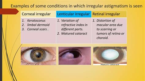Real Subjective Refraction In Astigmatism Pptx