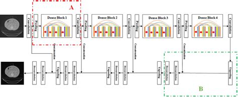Figure 1 From A Sparse View Ct Reconstruction Method Based On Combination Of Densenet And