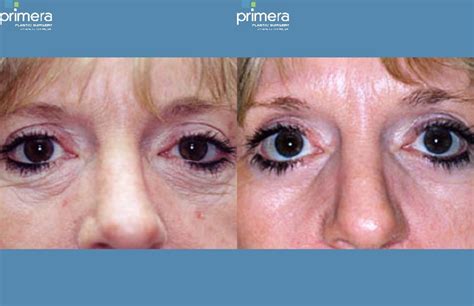 Blepharoplasty Before And After Pictures Case 269 Orlando Winter Park And Tampa Florida