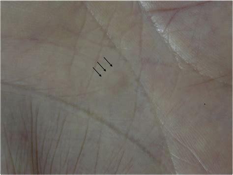 Skin Colored Firm Nodule On The Palm Arrows Download Scientific Diagram