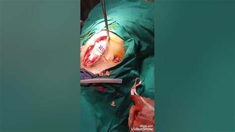 Bogota Bag Temporary Abdomin Closure Youtube