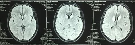 Hyperintensity Bilateral Caudate Nucleus And Lentiform Nucleus Download High Quality