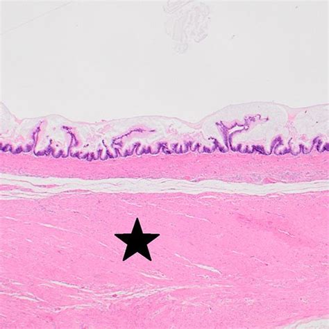 Low Grade Appendiceal Mucinous Neoplasm The Neoplastic Epithelium Download Scientific Diagram
