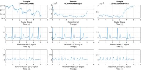 Human Health Monitoring Using Continuous Wave Radar And Deep Learning Matlab And Simulink