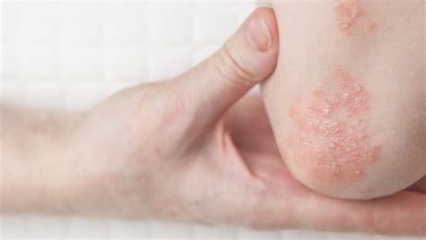 Skin Allergies Types Symptoms And Effective Management The Hype Naija