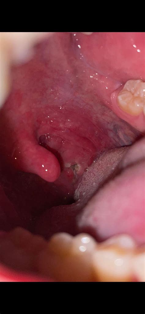 Tonsil Stones R Askdoctorsmeeee