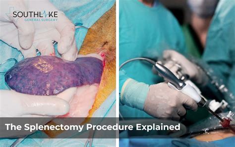 Spleen Removal Surgery Recovery