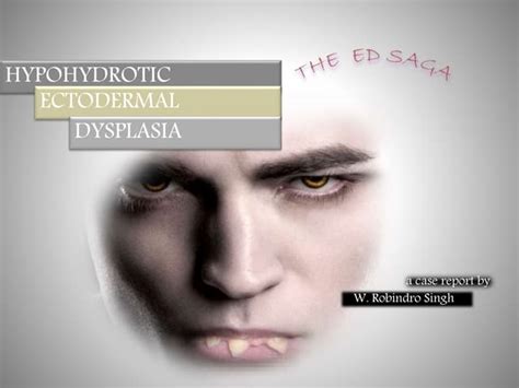 Ectodermal Dysplasia A Case Report And Overview Pptx