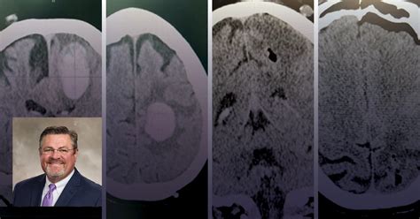 Surgeon Spotlight How Robotics Transformed The Care Of A Stroke Patient Globus Medical