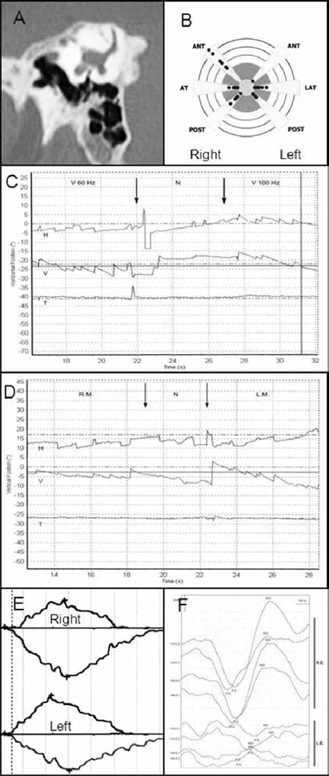 Vestibular Examinations In A 60 Year Old Woman With Right Superior Download Scientific Diagram