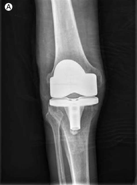 Soft Tissue Swelling Is Visible Around The Right Knee Joint A