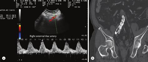 A Vascular Ultrasonography With Monophasic Flow In Right External Download Scientific Diagram