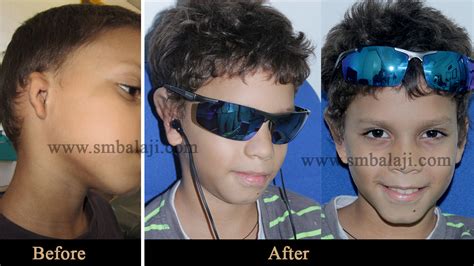 Microtia Ear Deformity Correction Ear Reconstruction India Best