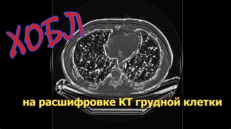 Диагноз ХРОНИЧЕСКАЯ ОБСТРУКТИВНАЯ болезнь легких ХОБЛ на РАСШИФРОВКЕ КТ органов грудной клетки