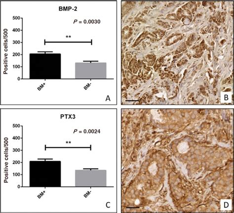 Can Microcalcifications Characteristics Predict The Risk Of Breast