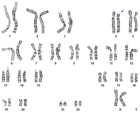 Deletion Karyotype