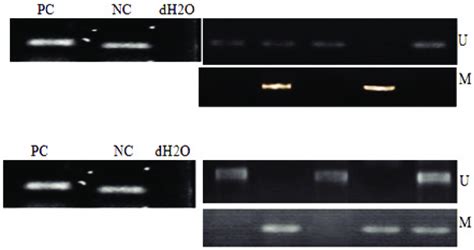 msp analysis of sox17 and runx3 genes in all patients and normal