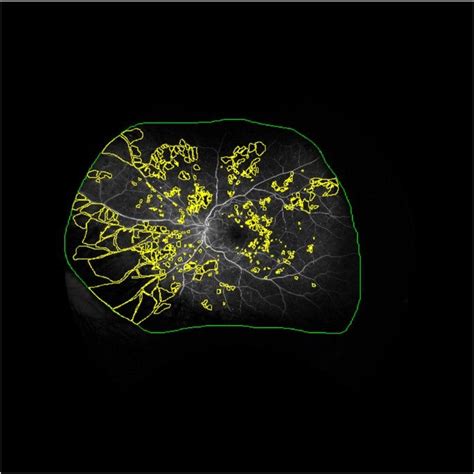 Ophthopedia On Linkedin Macula Vs Periphery In Diabetic Retinopathy Oct Angiography And Ultrawide…