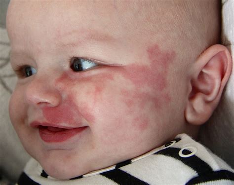 Angiome Plan Du Bébé Bis Journal Dune Naturopathe