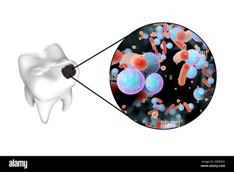 Tooth Decay Computer Artwork Of A Tooth With Cavity And Close Up View