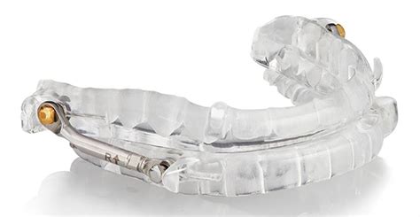 Types Of Oral Appliances Wesley Chapel Fl Somnodent® Avant Herbst