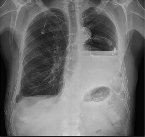 Frontiers Case Report Thoracic Duct Ligation For Left Sided Chylothorax After Pneumonectomy