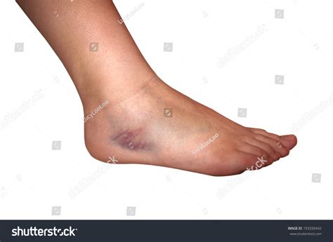 Bruised Ankle 1 329 Images Photos Et Images Vectorielles De Stock