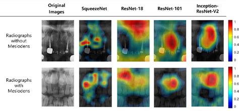 Figure 4 From Automated Mesiodens Classification System Using Deep Learning On Panoramic