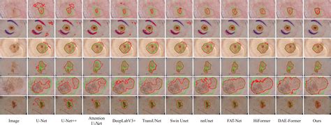 Cth Net A Cnn And Transformer Hybrid Network For Skin Lesion Segmentation Iscience