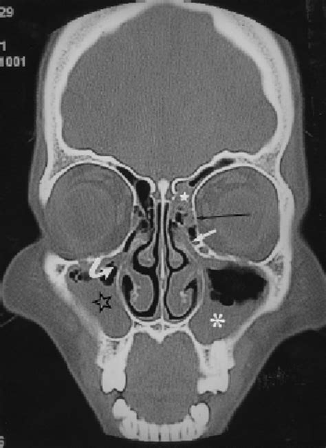 Ethmoid Infundibulum