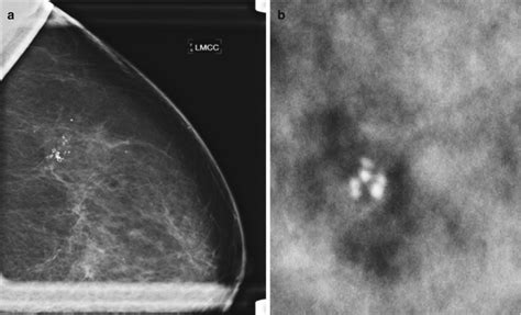 Approach To Calcifications Anesthesia Key