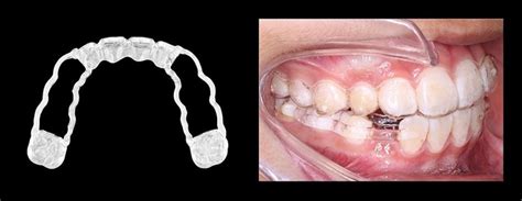 Orthodontic Innovation Direct 3d Printing Aligners