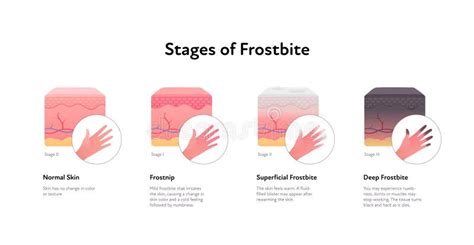 Frostbite Anatomical Infographic Vector Flat Healthcare Illustration Stages Of Hypothermia