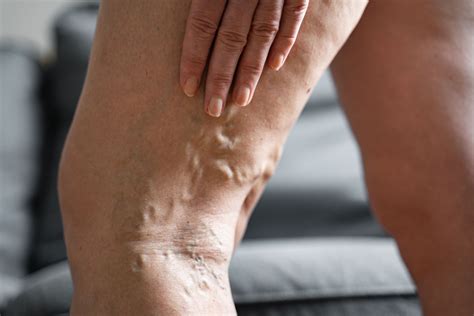 Symptoms And Causes Of Poor Circulation Michigan Vascular Center