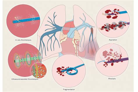 Pulmonary Embolism Treatment Algorithm