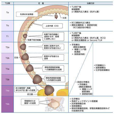 治療 膀胱がん再発転移など MSD oncology がんを生きる