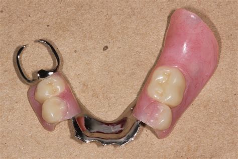 Boise Idaho Prosthodontics Semi Precision Attachment Rpd 3 Different