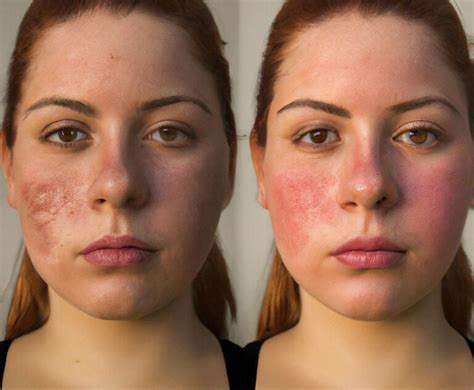 Rosacea Vad är Det Och Vad Kan Man Göra Själv Bodystore