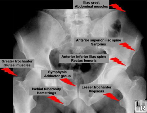 Learningradiology Pelvic Avulsion Fractures