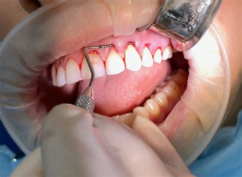 Multiple Miller Class I Gingival Recessions In The Area Of 21 24 Teeth Download Scientific Diagram