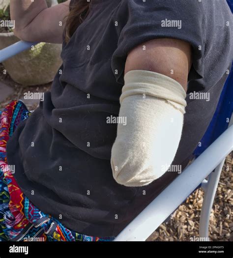 Amputated Arms At Sophia Shellshear Blog