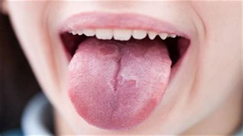 لسانك يعكس صحتك 6 علامات تشير إلى الإصابة بأمراض خطيرة مصراوى