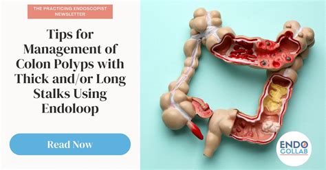 Endocollab™ Gi Endoscopy Education On Linkedin Tips For Management Of Colon Polyps With Thick