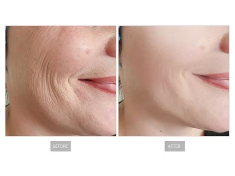 Decoding The Debate Microcurrent Vs Radio Frequency Konmison Decoding Microcurrent Vs Radio