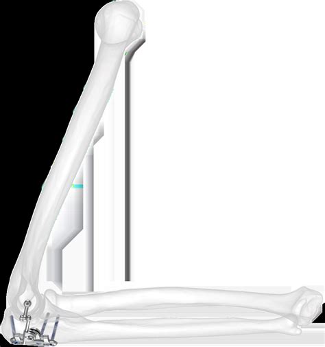 Fixation Skeletal Dynamics Explore Advanced Fixation Solutions — Medella Northwest