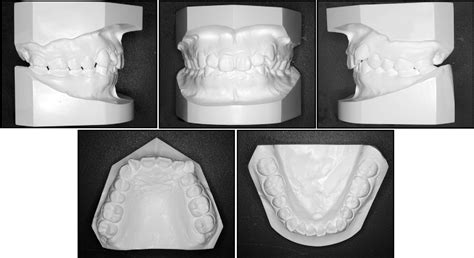 Overbite Correction Device