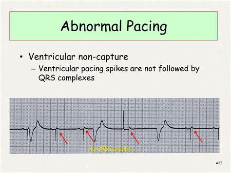 Temporary Pacemaker Easy To Learn For Picu Ppt