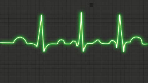 Normal Sinus Rhythm