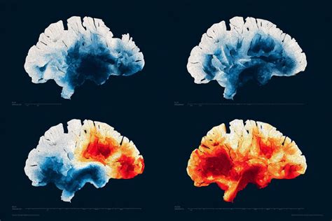 Fmri Signals Often Misread Neural Activity Neuroscience News