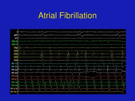 Ppt Update On The Treatment Of Atrial Fibrillation Powerpoint Presentation Id 1224426